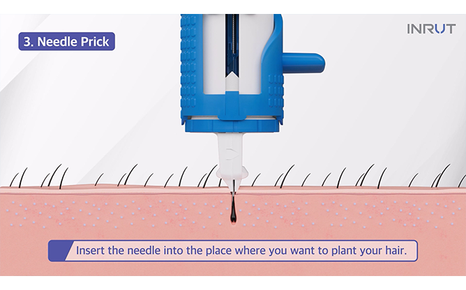 주식회사 오대 - 멀티 모발이식기 INRUT | 지식재산영상